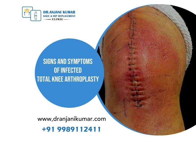 Signs And Symptoms Of Infected Total Knee Arthroplasty Dr Anjani